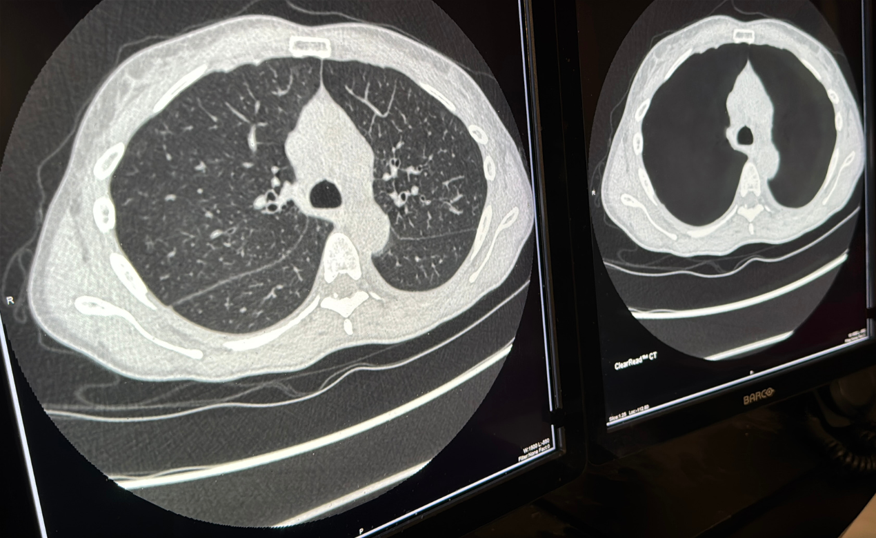 AI CT Lung Cancer Screenings Drive 30% Improvement in Life-Saving Early Detection